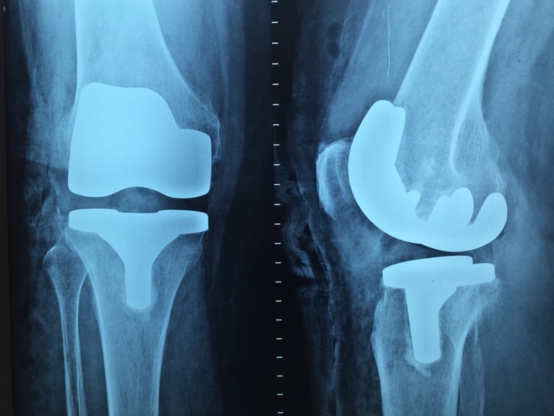 Orthopedic devices: how to assess safety in MRI?